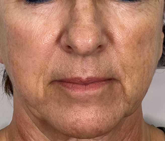 Reverso by INDIBA | Deep Fractional Radiofrequency for Skin Aging ...